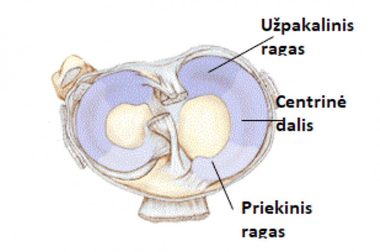 Menisko pažeidimas, plyšimas - Osteomedika