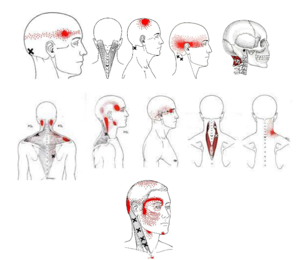 Kaklinės stuburo dalies skausmai | Galvos skausmai | Osteomedika